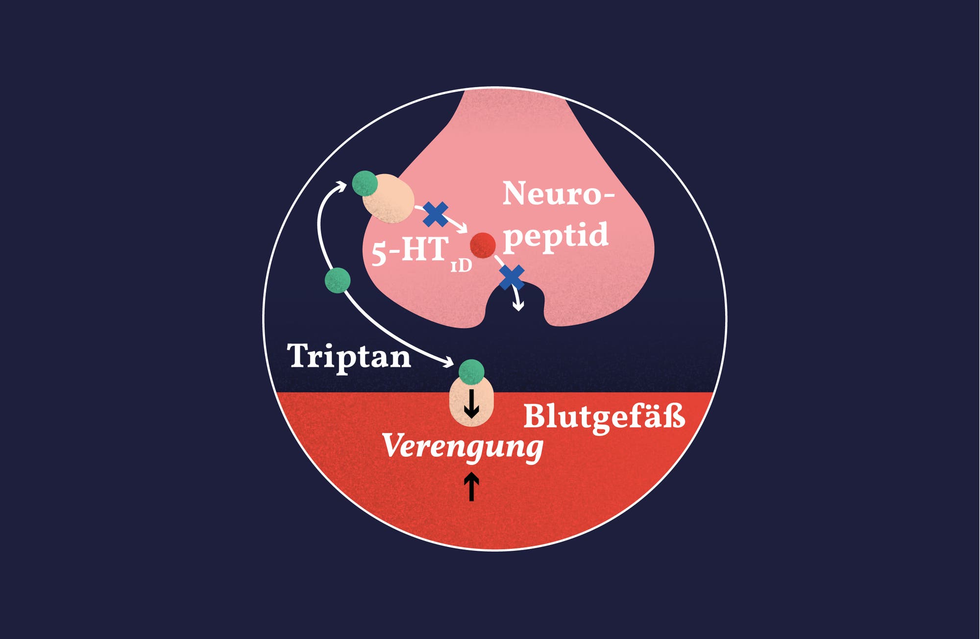 Schmerzen: Was hilft gegen Migräne? - Spektrum der Wissenschaft