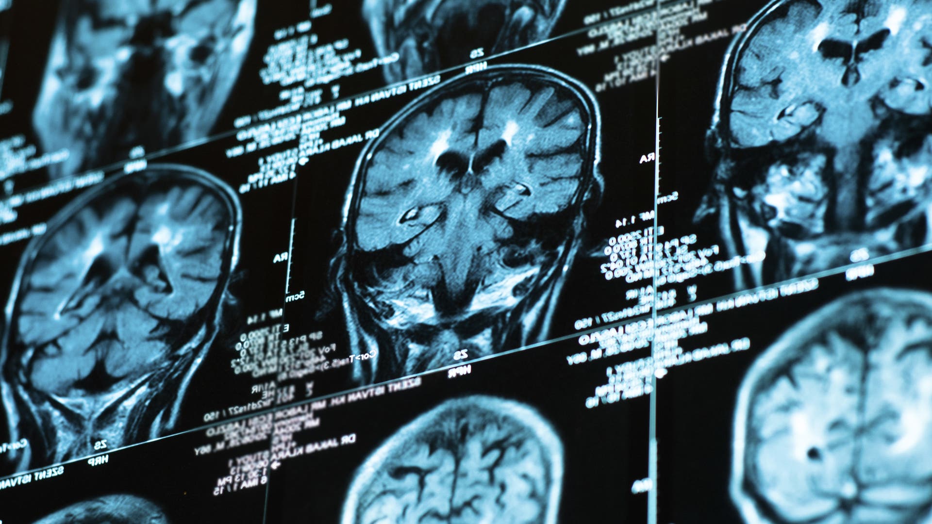 Schädel-Hirn-Trauma: Menschliches Gehirn besonders anfällig für ...