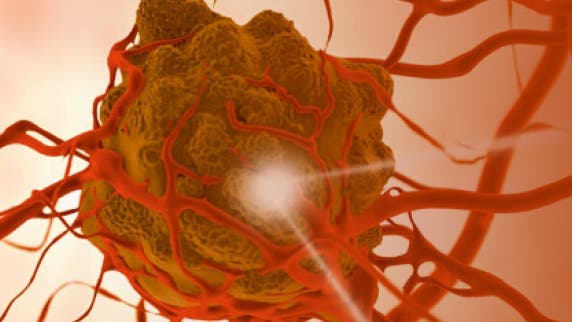 Krebsmedizin: Der Blick fürs Wesentliche - Spektrum der Wissenschaft