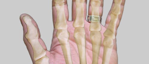 Handwurzelknochen, heiter - Spektrum der Wissenschaft