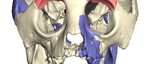 Paläontologie: Schädel eines ausgestorbenen Lemurs zusammengepuzzelt ...